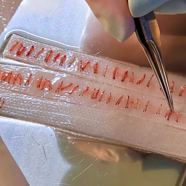 Folículo Capilar e Unidade Folicular: Estrutura, função e preço